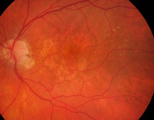 Age Related Macular Degeneration (AMD) | Olelo