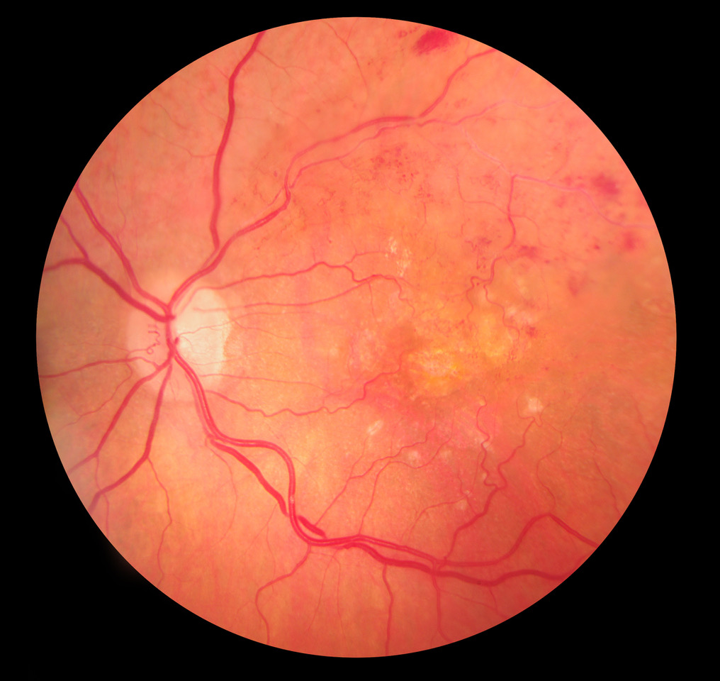 Age Related Macular Degeneration (AMD) | Olelo